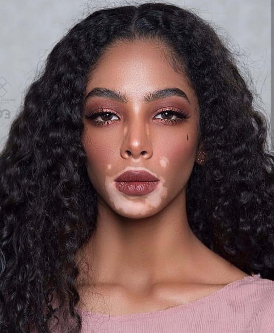 Vitiligo Models Winnie & Shahad Dominate Vogue Arabia, Read The ...