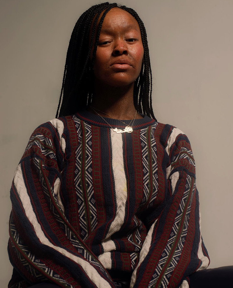 #MODELCRUSH: "I Never Saw Models With My (Rare 1 in 100,000) Skin Condition So I Became One ...