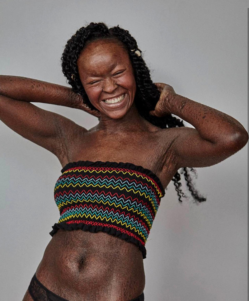 #MODELCRUSH: "I Never Saw Models With My (Rare 1 in 100,000) Skin Condition So I Became One ...