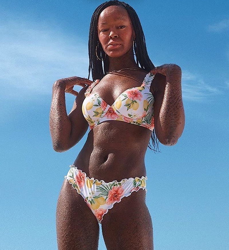 #MODELCRUSH: "I Never Saw Models With My (Rare 1 in 100,000) Skin Condition So I Became One ...