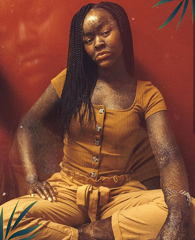 #MODELCRUSH: "I Never Saw Models With My (Rare 1 in 100,000) Skin Condition So I Became One ...